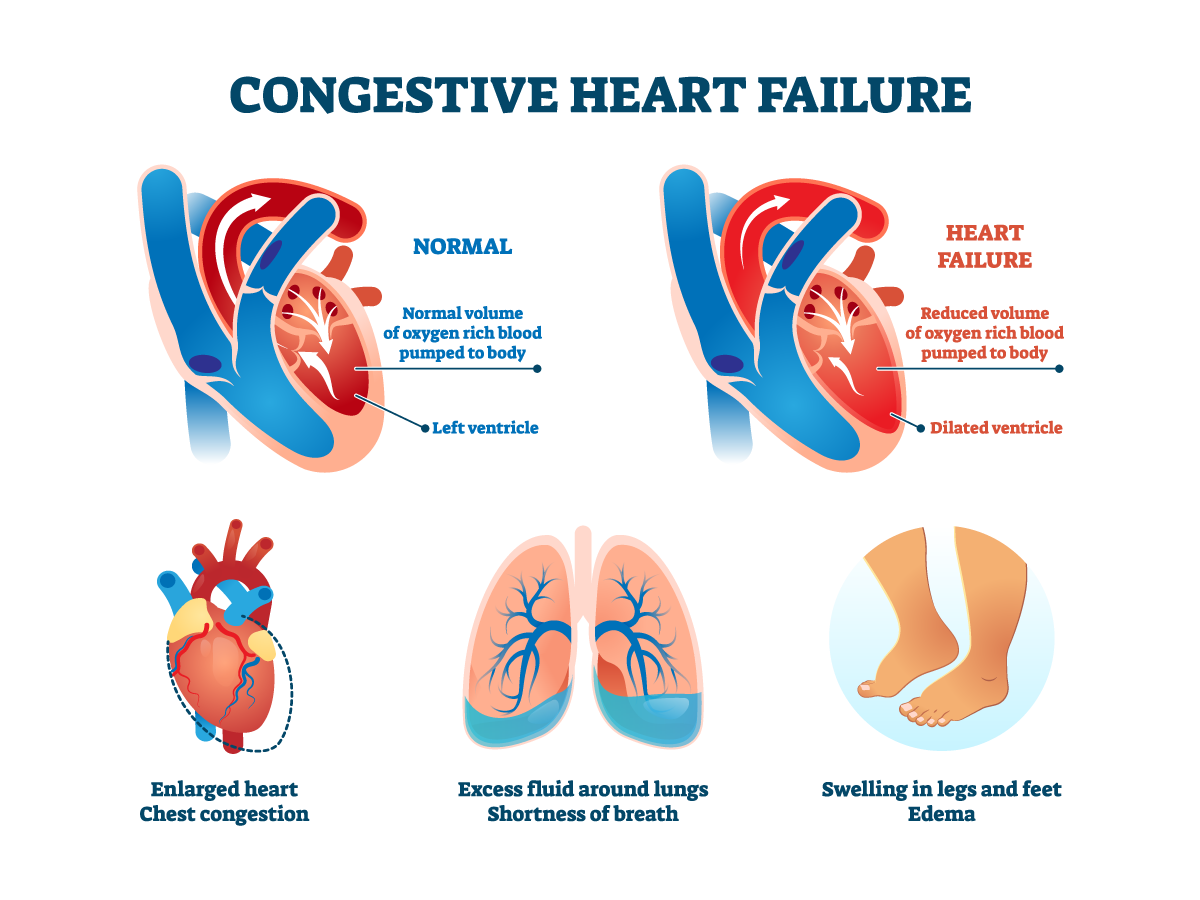 What Are the Four Stages of Congestive Heart Failure? | Sage Family of ... What Are the Four Stages of Congestive Heart Failure? | Sage Family of ...