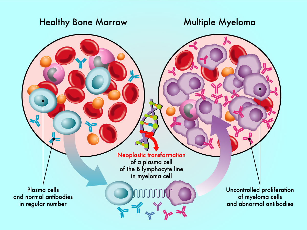 What Is the Main Cause of Death from Multiple Myeloma? | Sage Family of ...