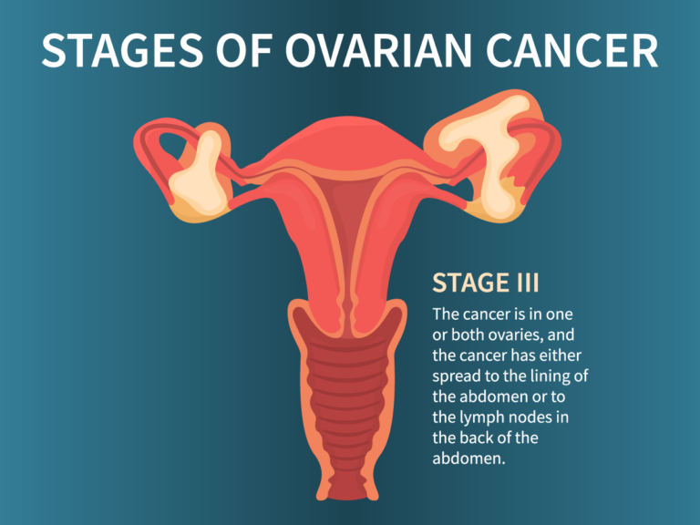 Stage 4 Ovarian Cancer Meaning Treatment And Survival Rates Sage